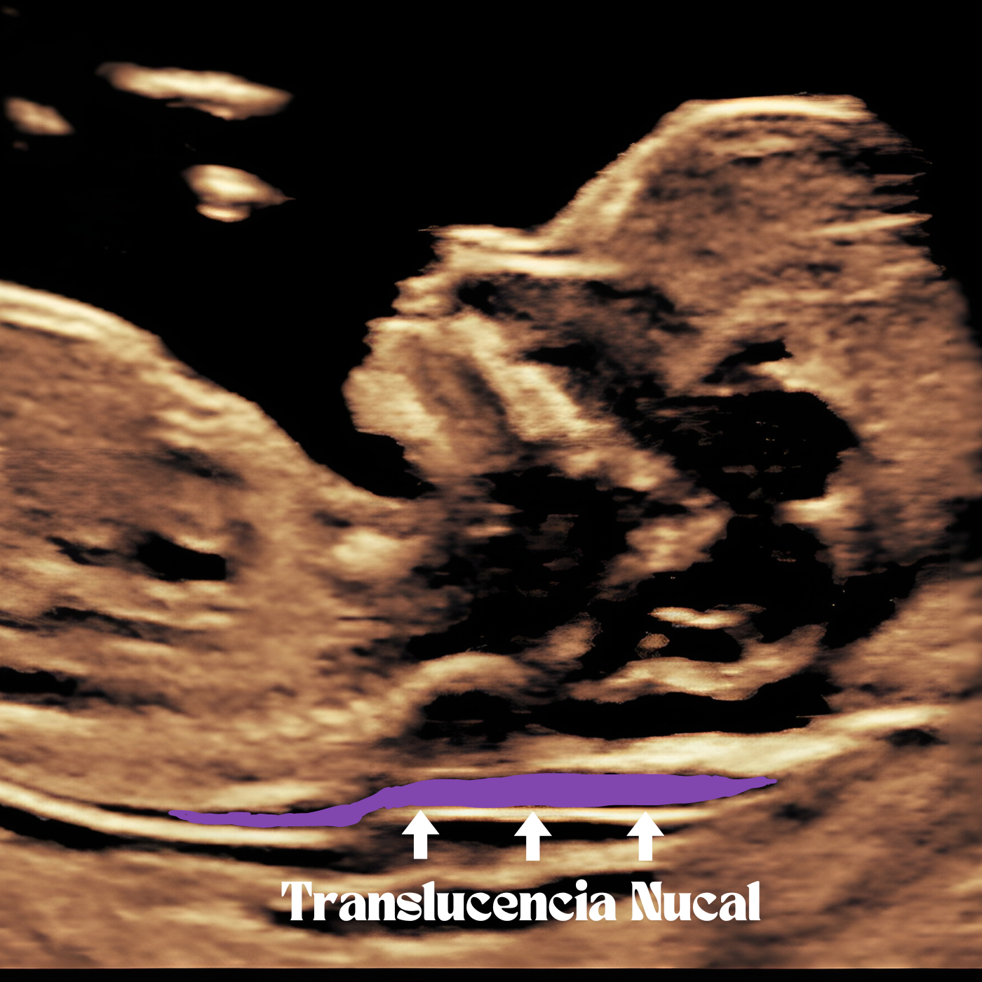 La ecografía Genética: Guía completa.